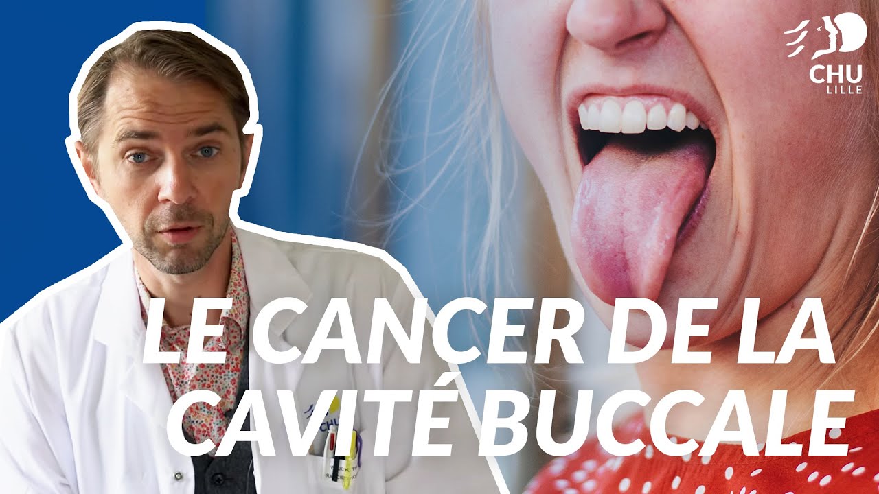 Le cancer de la cavité buccale - CHU Lille
